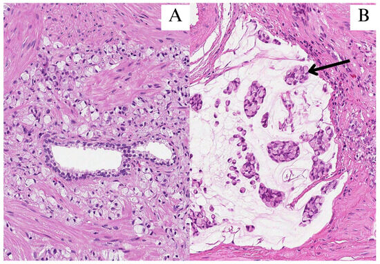 Prostate Adenocarcinoma with Signet-Ring Cells and Features of Mucin: A ...