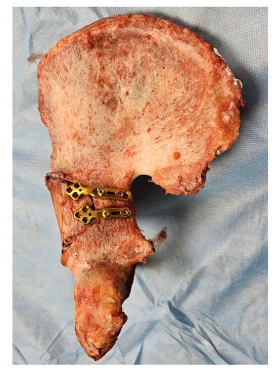 Medicina | Free Full-Text | Biomechanical Comparison of Fixation ...