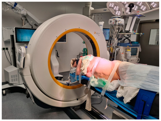 Surgical Treatment of Calcified Thoracic Herniated Disc Disease via the ...