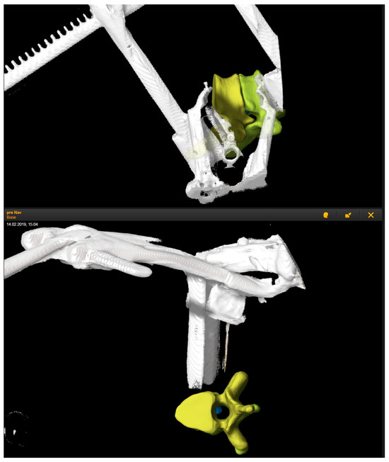 Surgical Treatment of Calcified Thoracic Herniated Disc Disease via the ...