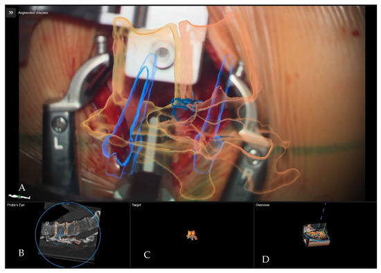 Surgical Treatment of Calcified Thoracic Herniated Disc Disease via the ...