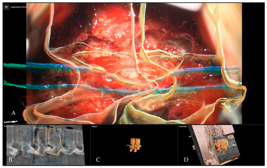 Surgical Treatment of Calcified Thoracic Herniated Disc Disease via the ...