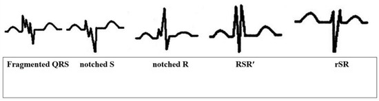 The Relationship between Fragmented QRS and Myocardial Injury in ...