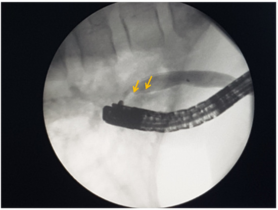 Biliary Ascariasis in a Pediatric Patient in Lithuania: Case Report and ...