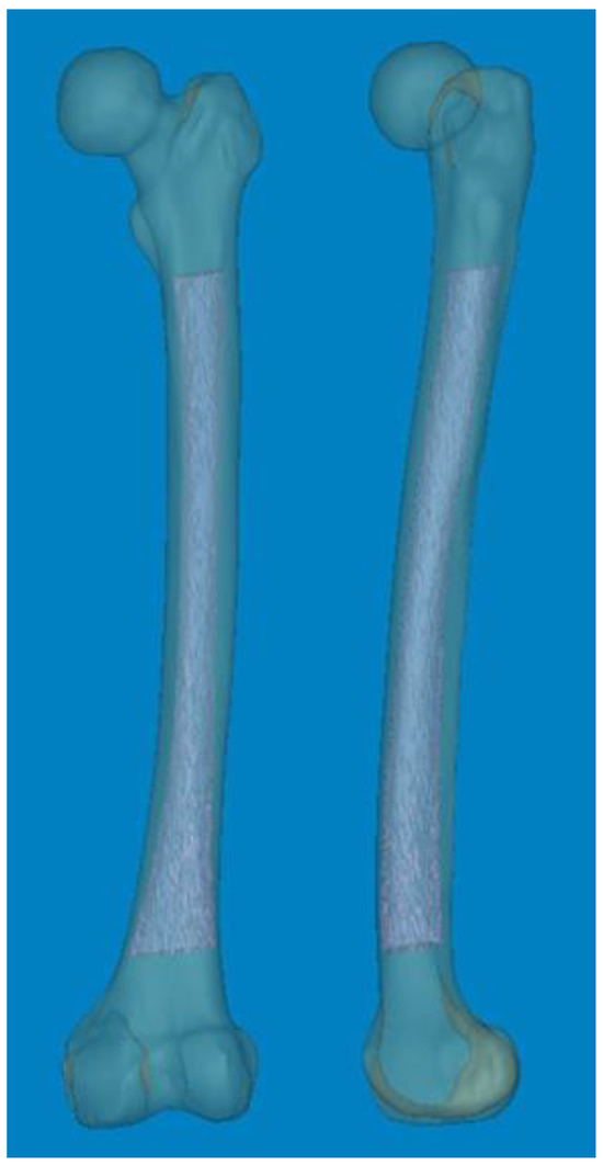 Three-Dimensional Bowing Measurement of Distal Femur at Actual Size and ...