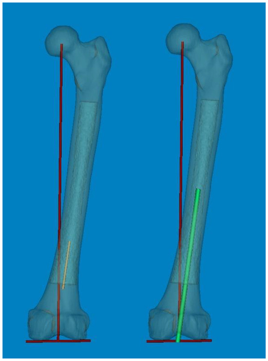 Three-Dimensional Bowing Measurement of Distal Femur at Actual Size and ...