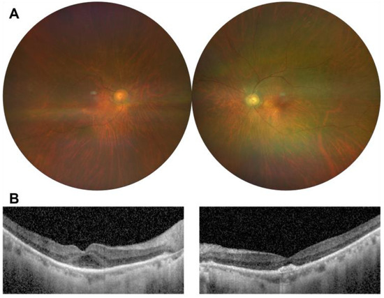 Bilateral Visual Impairment following Combination Chemotherapy with ...