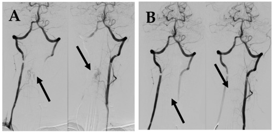 A Rare Case of Cervical Spinal Arteriovenous Malformation: A Case Report