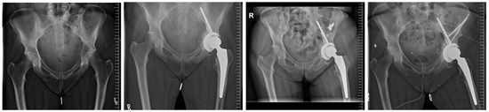 The Modified Harrington Procedure for Metastatic Peri-Acetabular Bone ...