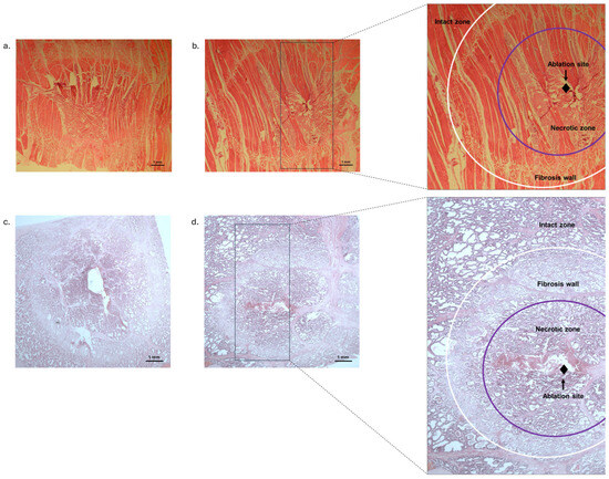 Relationship between Lesion Parameters after Radiofrequency Catheter ...