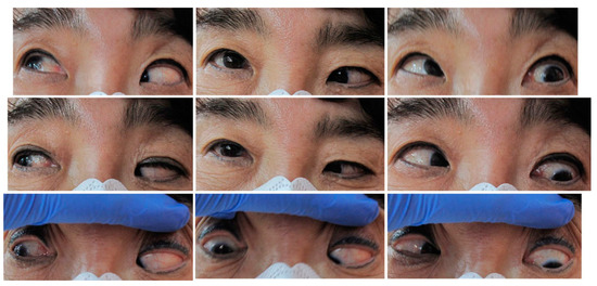 Medial Rectus Disinsertion for the Management of Large-Angle Sensory ...