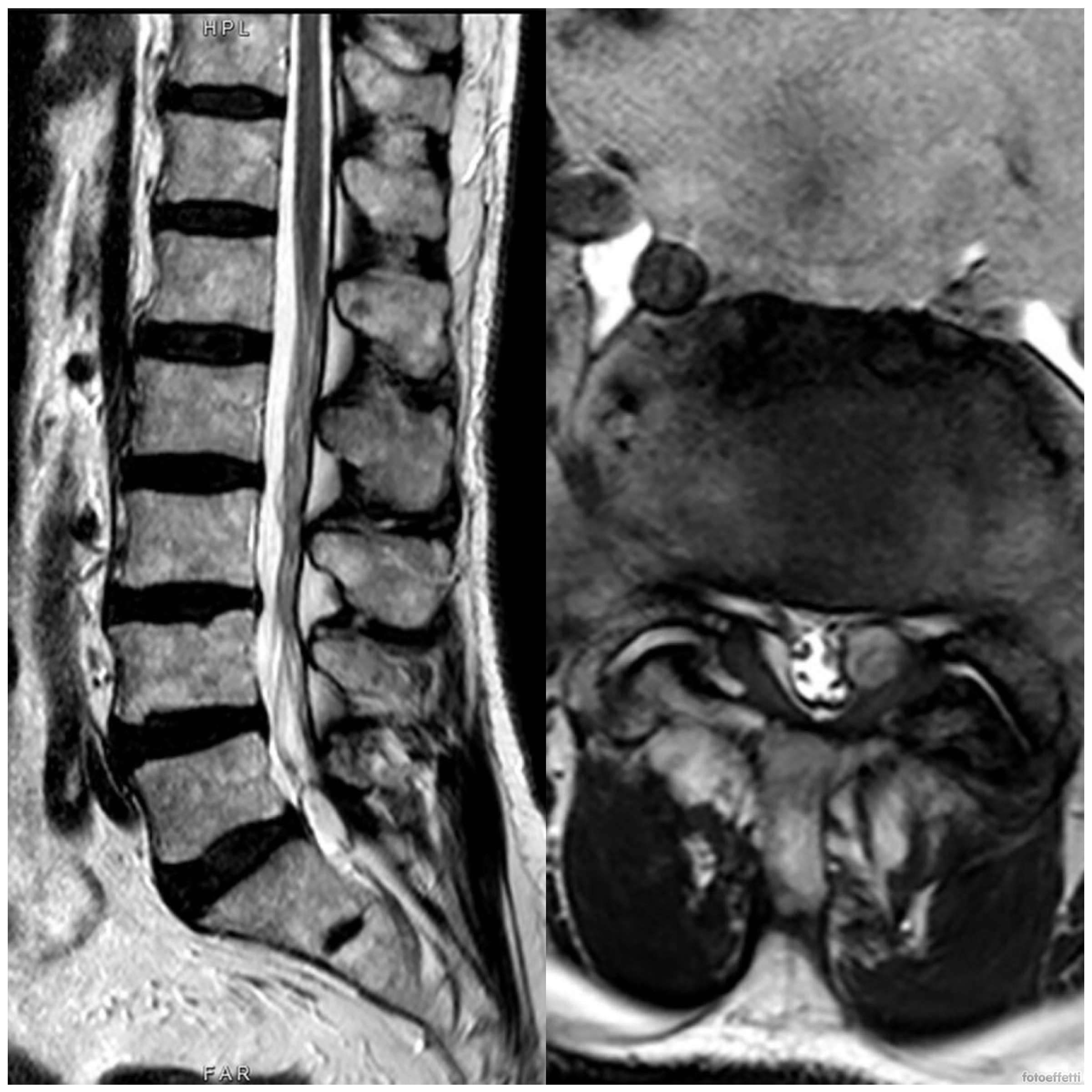 Medicina Free Full Text Spontaneous Resolution Of Symptomatic Synovial Cysts Of The Lumbar