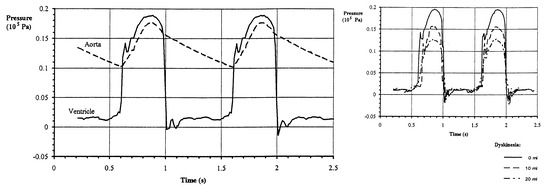 Characteristics of Akinetic and Dyskinetic Left Ventricular Aneurysms ...