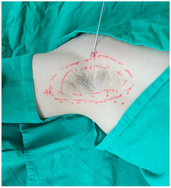 Comparative Study of 1444 nm Laser Monotherapy versus Integrated ...
