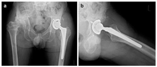 Long-Term Outcomes and a Radiological Assessment of Hydroxyapatite ...