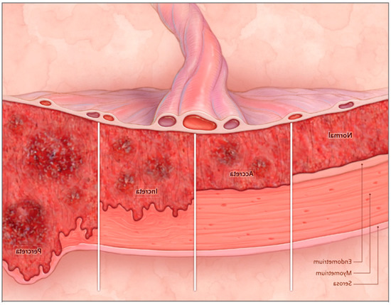 Placenta Accreta Spectrum (PAS): Diagnosis, Clinical Presentation ...