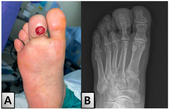 A Rare Case of Solitary Neurofibroma Misdiagnosed as Diabetic Foot ...