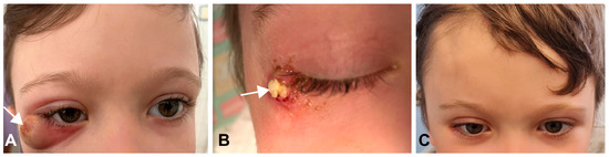 Modified Orbitozygomatic Craniotomy Approach for a Recurrent Orbital ...
