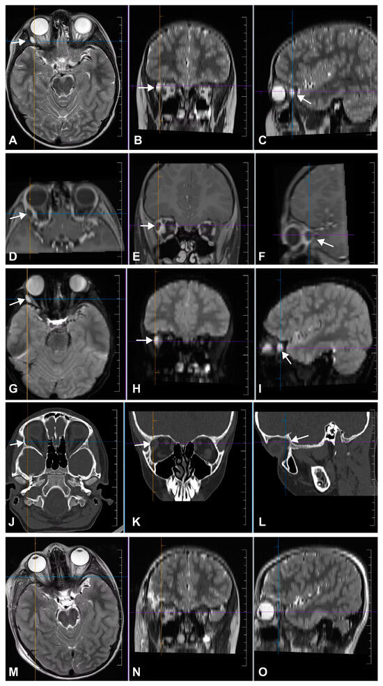 Modified Orbitozygomatic Craniotomy Approach for a Recurrent Orbital ...