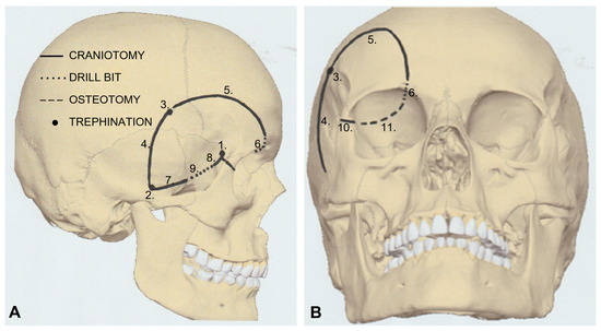 Medicina | Free Full-Text | Modified Orbitozygomatic Craniotomy ...