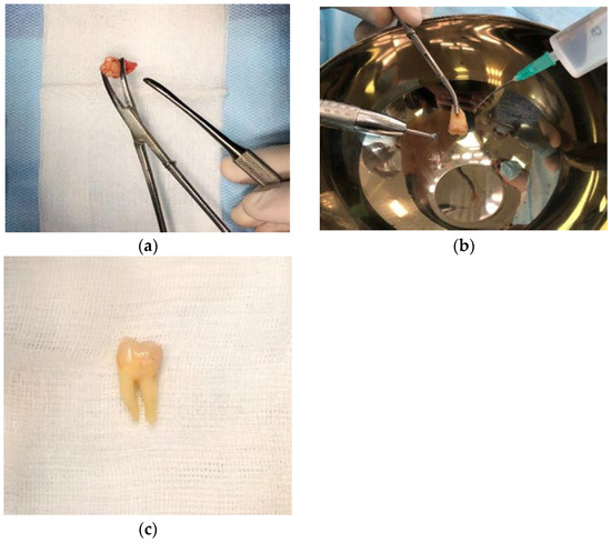 Comparative Effectiveness of an Autologous Dentin Matrix for Alveolar Ridge Preservation