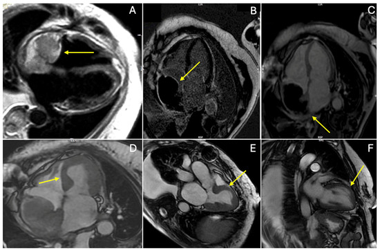 Cardiac Angiosarcoma in the Right Atrium Treated by Surgical Resection