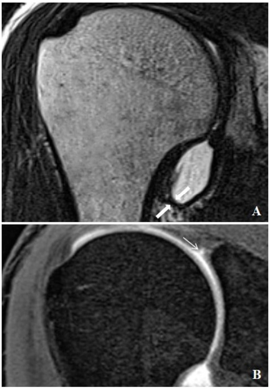 Relationship between SLAP Lesions and Shoulder Joint Capsule Thickness ...