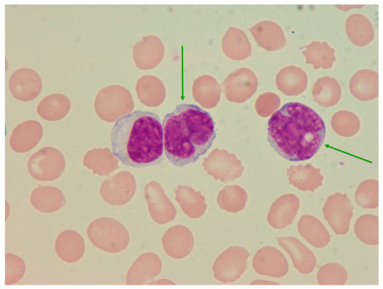 Atypical Plasma Cell Leukemia Mistaken for Acute Leukemia: A Case Report