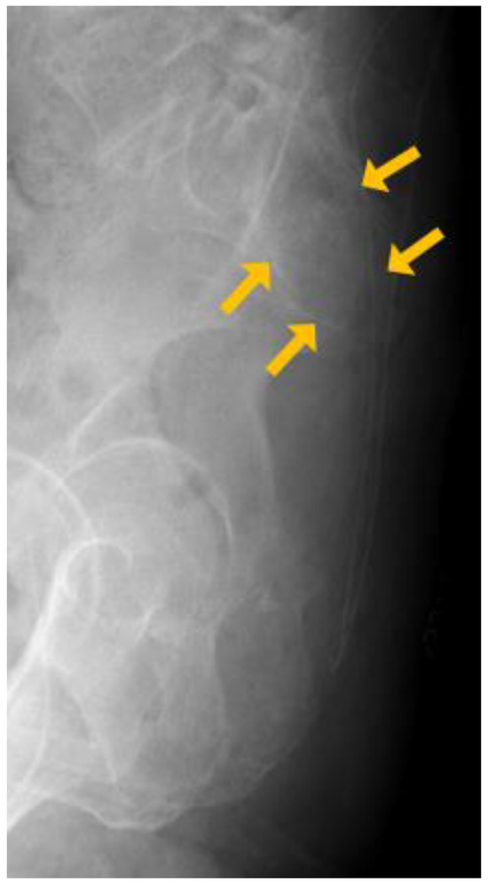 Coccygodynia in a Long-Term Cancer Survivor Diagnosed with Metastatic ...