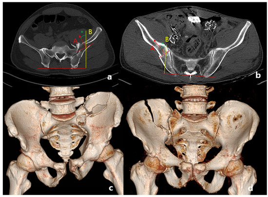Anterior Sacroiliac Fracture Dislocation: A Comparative Radiologic ...