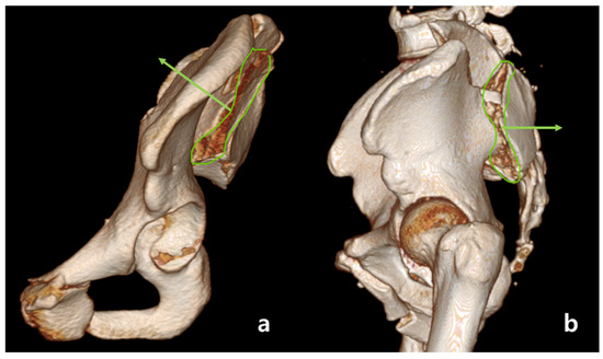 Anterior Sacroiliac Fracture Dislocation: A Comparative Radiologic ...