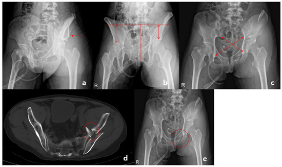 Anterior Sacroiliac Fracture Dislocation: A Comparative Radiologic ...