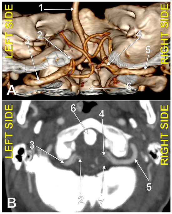 A Prevalence Anatomic-Imaging Study of the Posterior Inferior ...