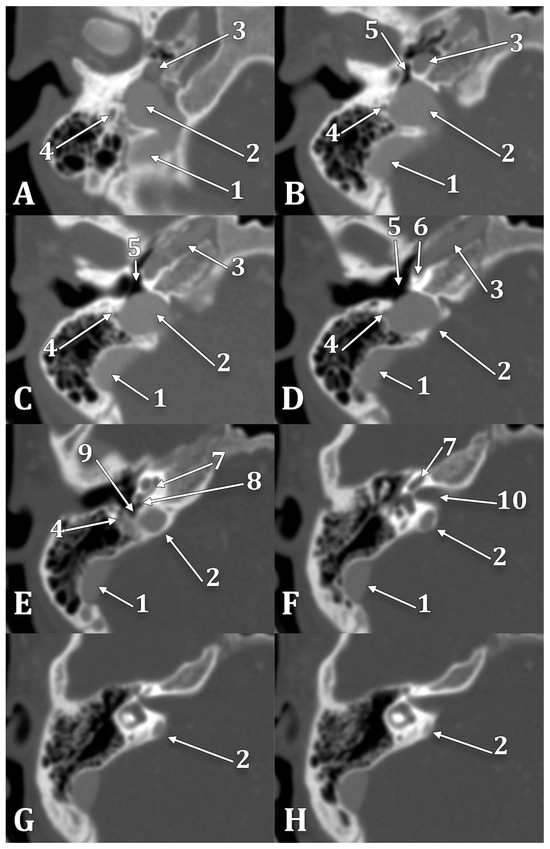 Anatomical Variations of the Jugular Bulb: A Critical and Comprehensive ...