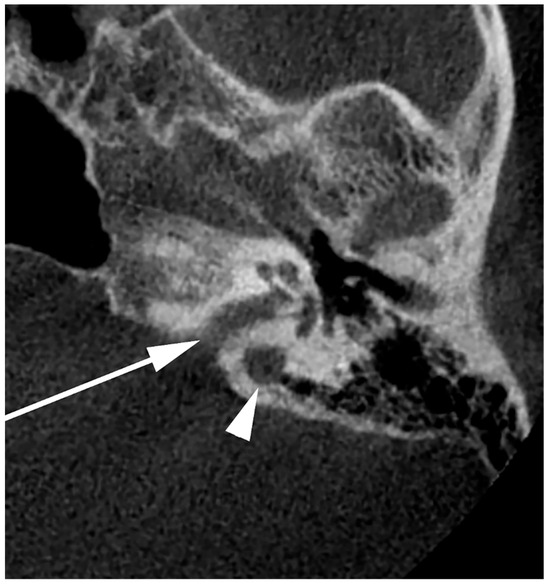 Anatomical Variations of the Jugular Bulb: A Critical and Comprehensive ...