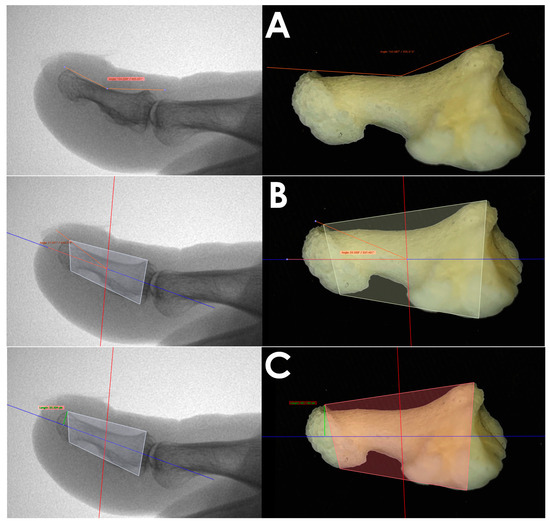 Hallux Dorsal Curvature of the Distal Phalanx and Its Possible ...