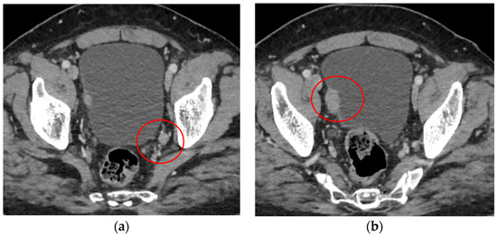 Simultaneous Prostate and Bladder Cancer with Collision Lymph Node ...