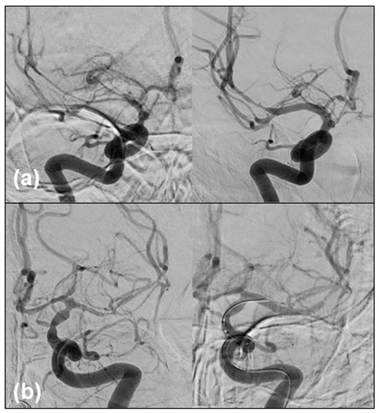 Symptomatic Vasospasm Refractory to Clazosentan after Subarachnoid ...