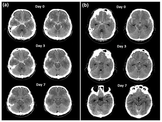 Symptomatic Vasospasm Refractory to Clazosentan after Subarachnoid ...