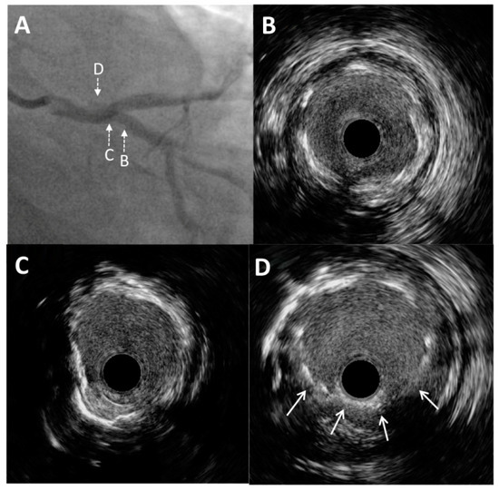 The Role of Intravascular Ultrasound in the Evaluation and Treatment of ...
