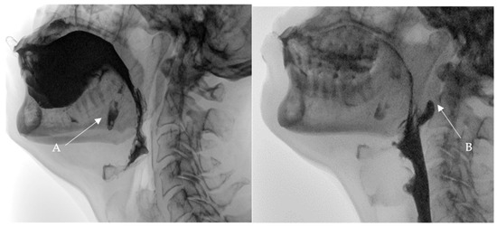Oral and Pharyngeal Diverticula: A Rare Case of Dysphagia and ...