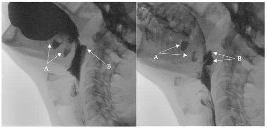 Oral and Pharyngeal Diverticula: A Rare Case of Dysphagia and ...