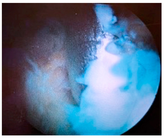 Arthroscopic Debridement Enhanced by Intra-Articular Antibiotic-Loaded ...