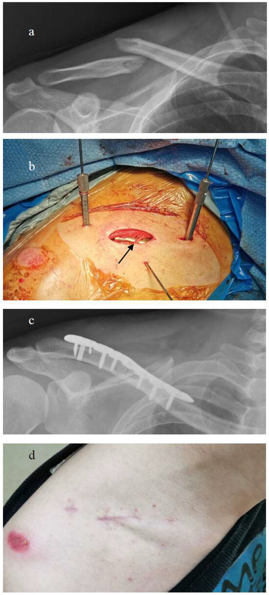Minimally Invasive Plate Osteosynthesis with Mini-Open Technique and ...