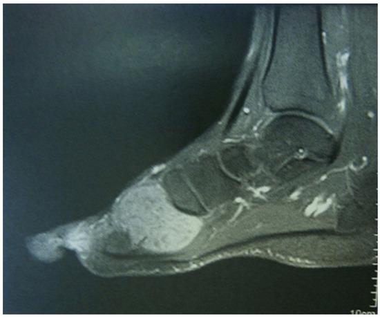 Treatment Modalities for Refractory-Recurrent Tenosynovial Giant Cell ...