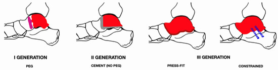 Avascular Necrosis of the Talus: Diagnosis, Treatment, and Modern ...