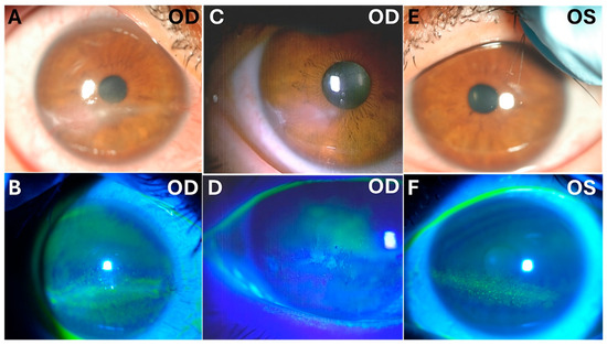 Neuronal Intranuclear Inclusion Disease with a Corneal Disorder: A Case ...