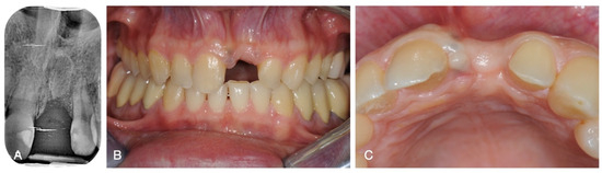 Horizontal Bone Augmentation with Simultaneous Implant Placement in the ...