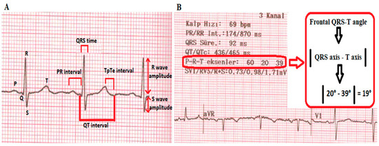 A Novel Electrocardiographic Marker to Predict the Development of ...