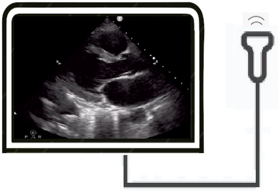 PiCCO or Cardiac Ultrasound? Which Is Better for Hemodynamic Monitoring ...
